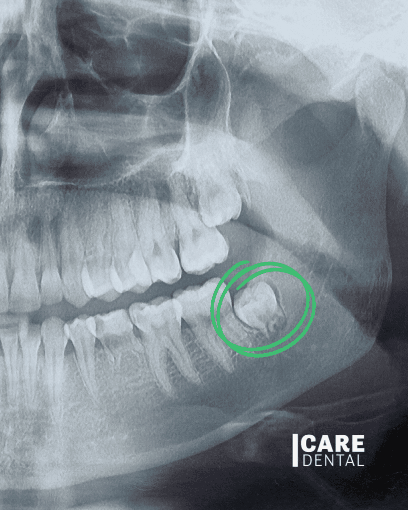 Wisdom Teeth! - Care Dental